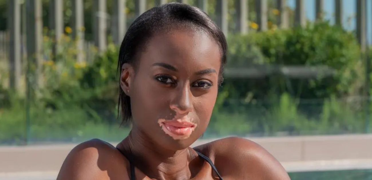 Miss France 2024 : Estelle Mendy (Miss Normandie) atteinte de vitiligo ...