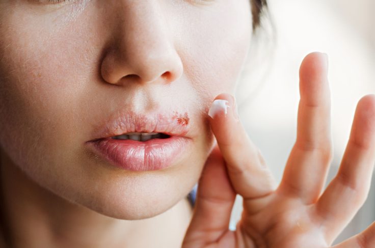 Herpès labial : comment soigner un bouton de fièvre déjà sorti